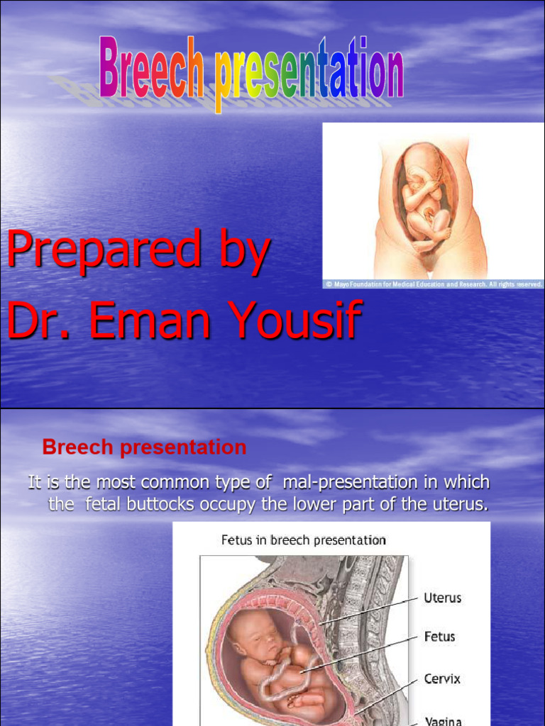 Breech & Shoulder Dystocia | PDF | Childbirth | Human Development