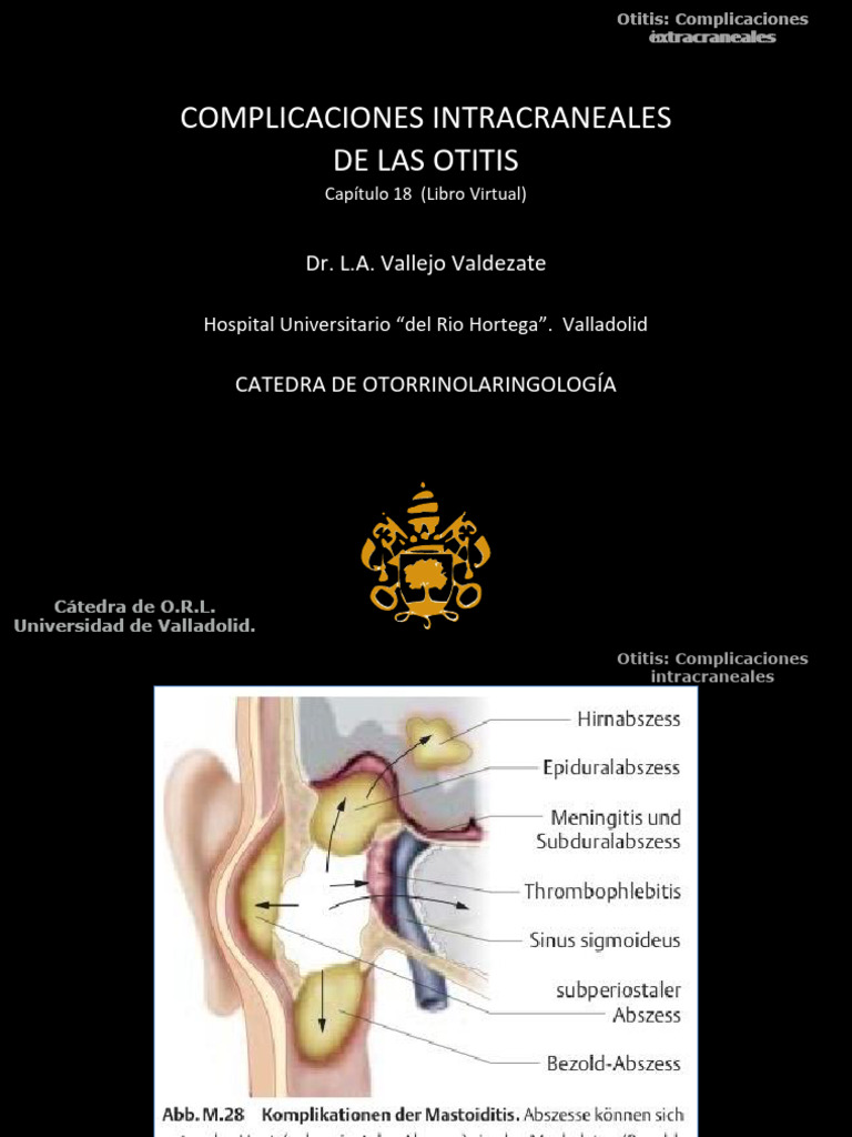 Complicaciones Intracraneales de Las Otitis | PDF | Meningitis | Septicemia