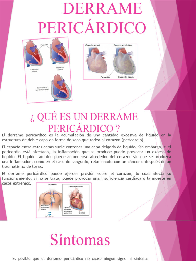 Derrame Pericárdico | PDF