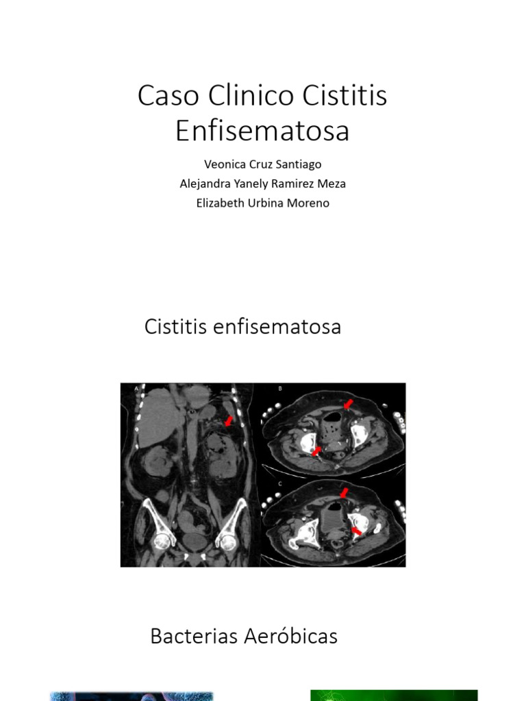 Caso Clinico Cistitis | PDF | Ciencia y matemáticas