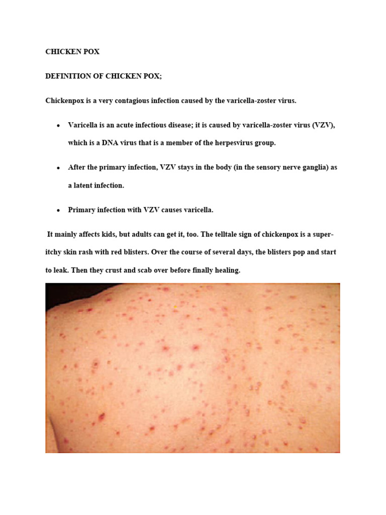CHICKEN POX | PDF