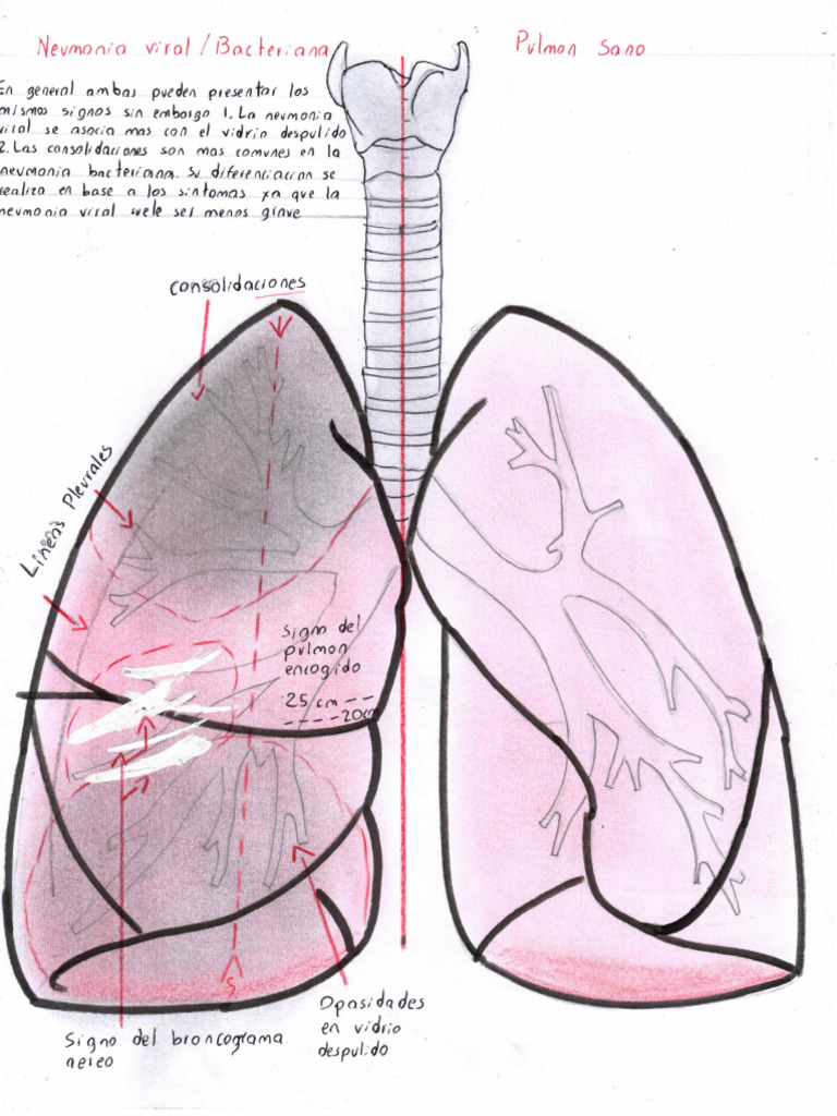 Signos Radiologicos de La Neumonia Viral y Bacteriana | PDF