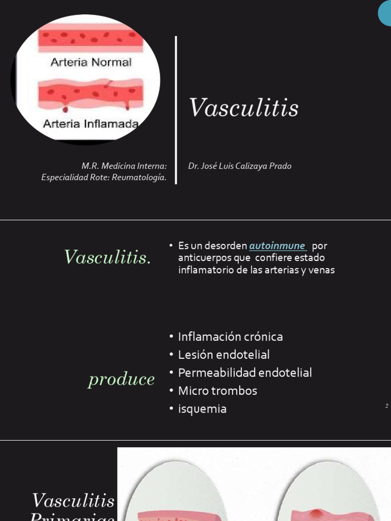 Vasculitis | PDF