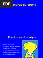 Chapitre 6 - Fractures Du Cotyle | PDF | Orthopédie | Médecine clinique
