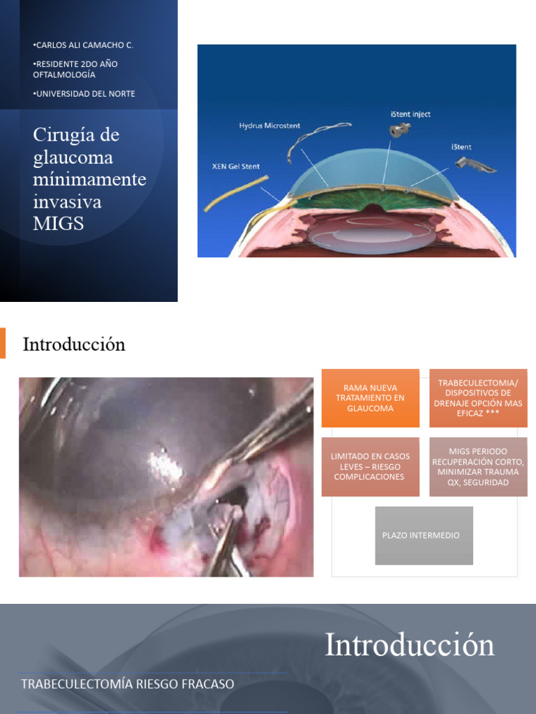 MIGS Glaucoma CAC | Descargar gratis PDF | Glaucoma | Medicina