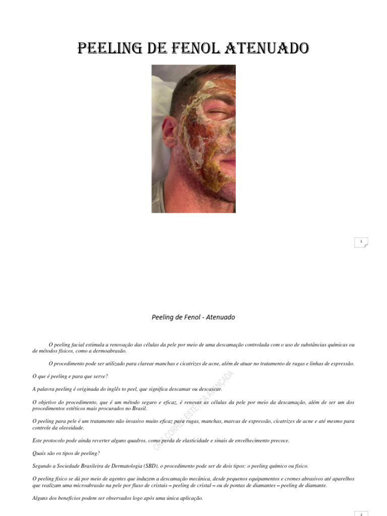 Peeling de Fenol Atenuado: Eficácia e Indicações | PDF | Pele ...