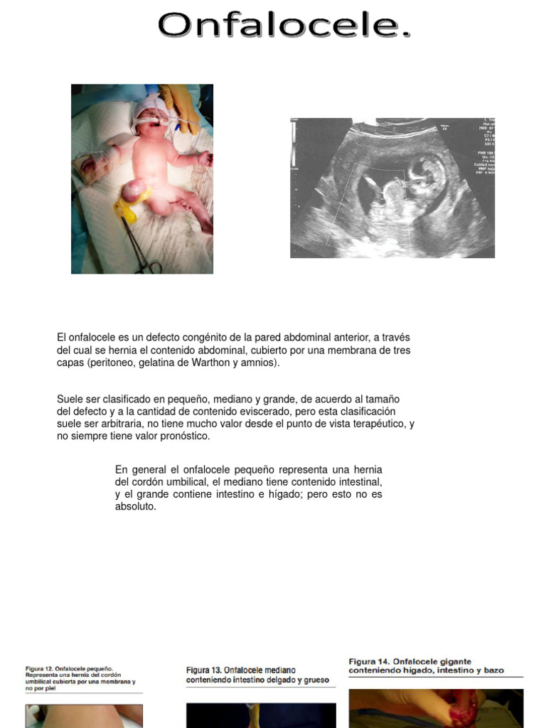 Onfalocele | PDF