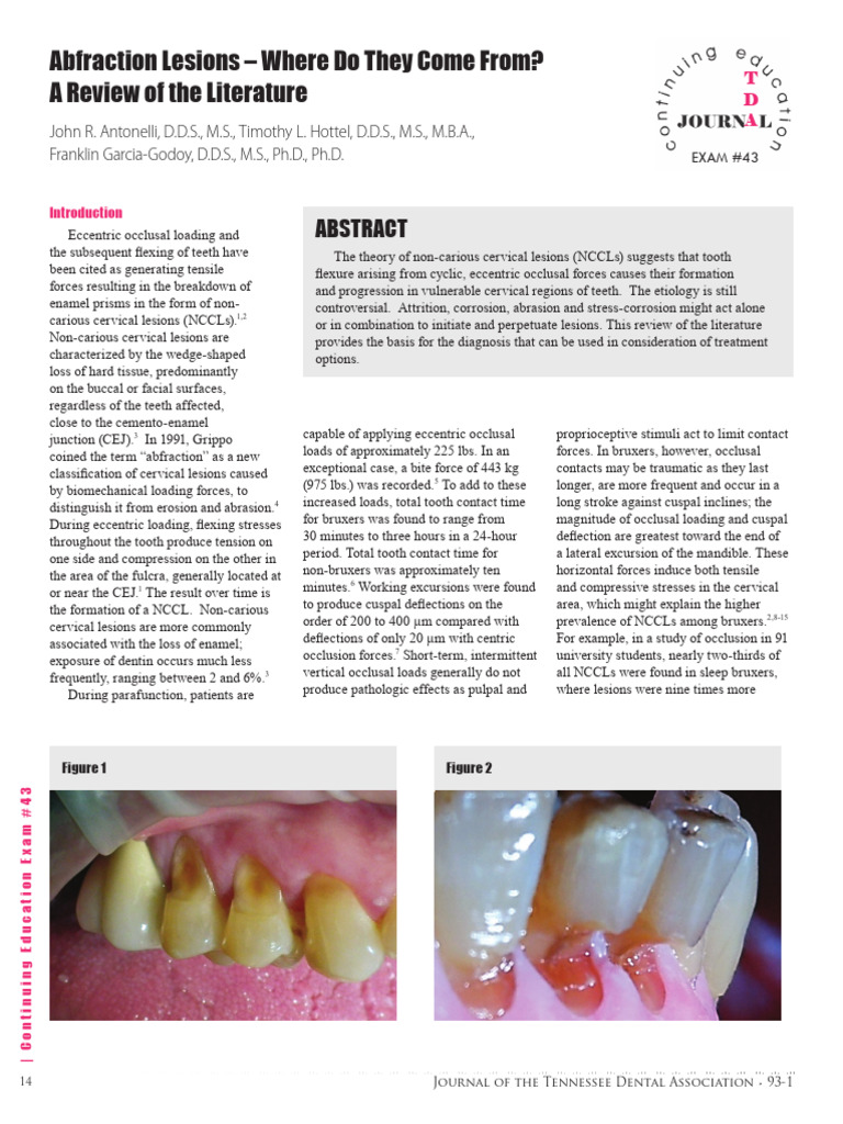 Abfraction Lesions - Where Do They Come From A Review of The Literature ...