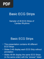 ECG Arrhythmias: PAC, PJC, PVC Guide | PDF | Cardiac Electrophysiology ...
