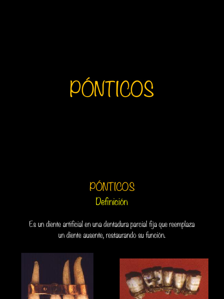 Guía Completa de Pónticos Dentales | PDF | Dentadura postiza | Ramas de ...
