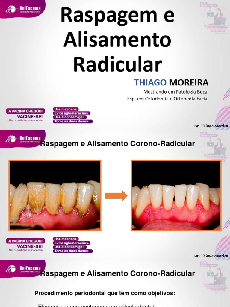 04 - Raspagem e Alisamento Radicular | PDF