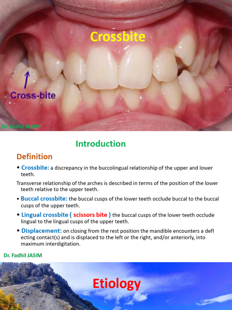 14 Crossbite 2021 | PDF