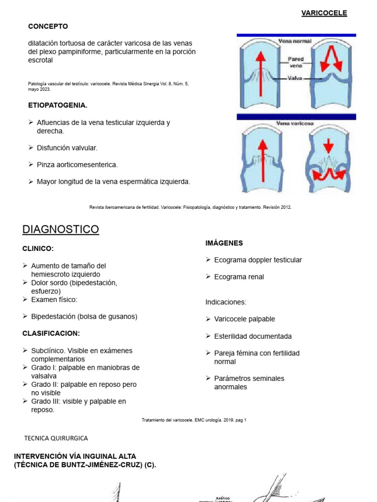 Varicocele | PDF | Medicina | Medicina CLINICA