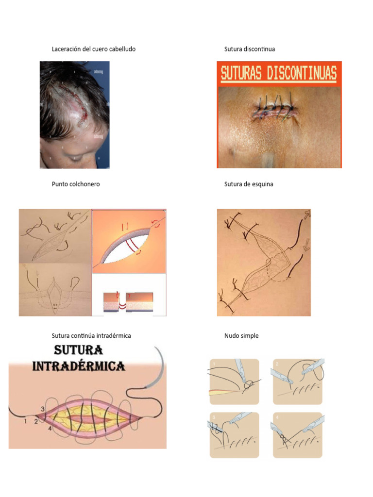 7 Tipos de Suturas | PDF