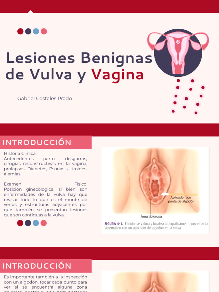 Lesiones Benignas de Vulva y Vagina | PDF | Medicina CLINICA | Especialidades Medicas