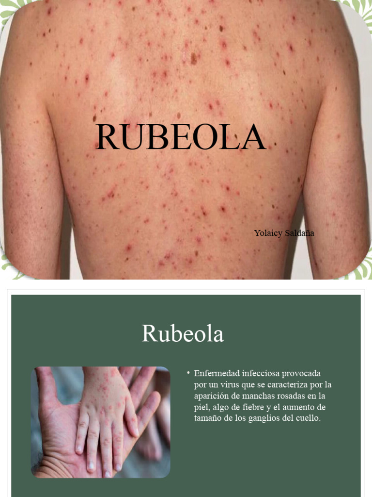 Rubeola (1) | PDF | Microbiología | Enfermedades animales
