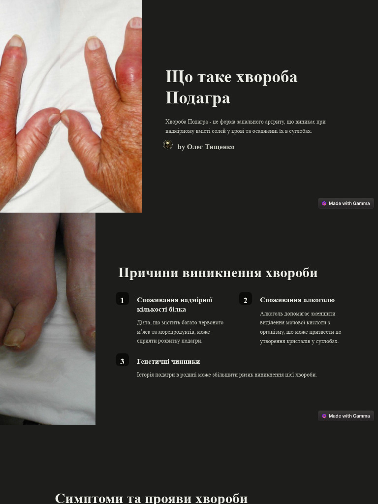 Sho Take Hvoroba Podagra | PDF