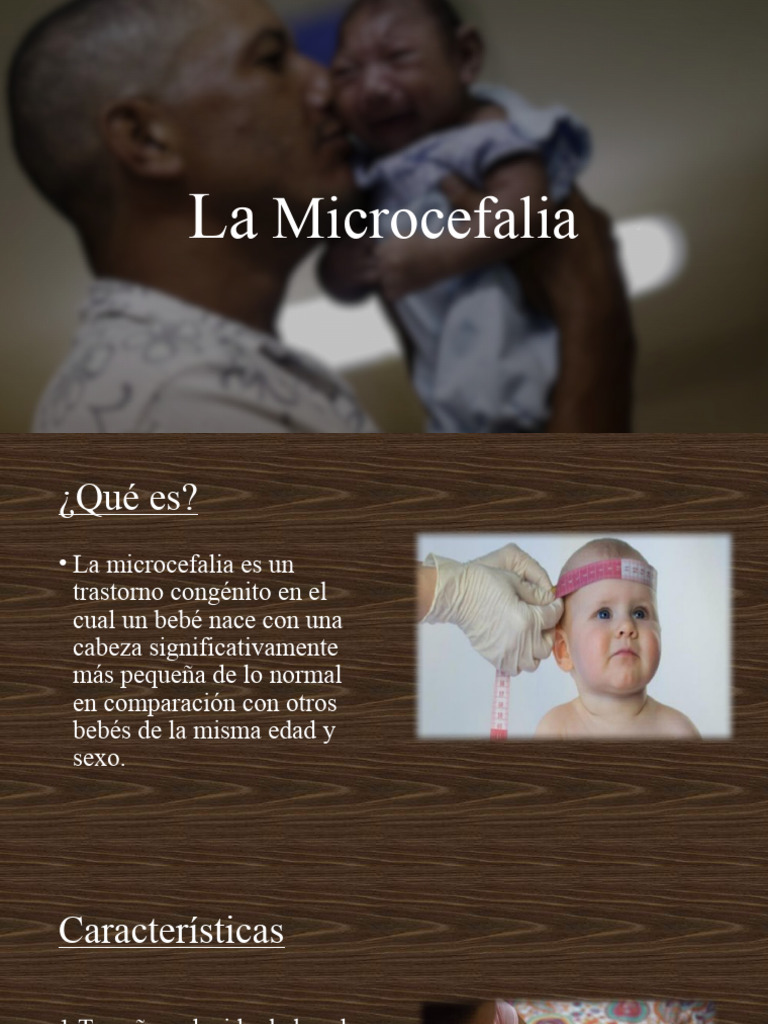 Microcefalia | PDF