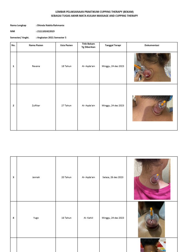 Dhinda Nabila Cupping Therapy | PDF