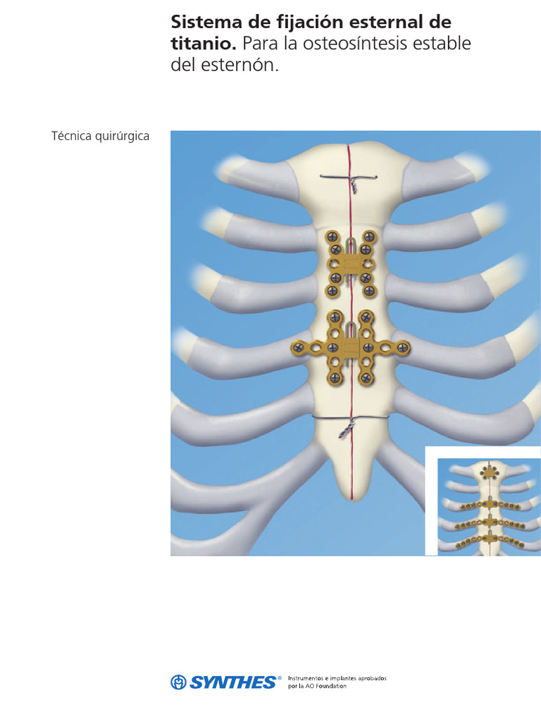 Fijación Esternal de Titanio: Técnica Quirúrgica | PDF | Tornillo ...