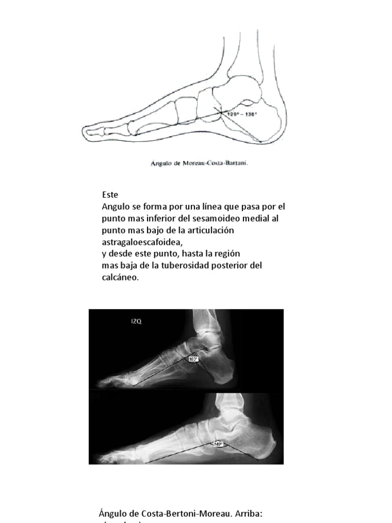 Ángulo de Costa-Bartani en Pie Plano | PDF | Dedo del pie | Sistema ...