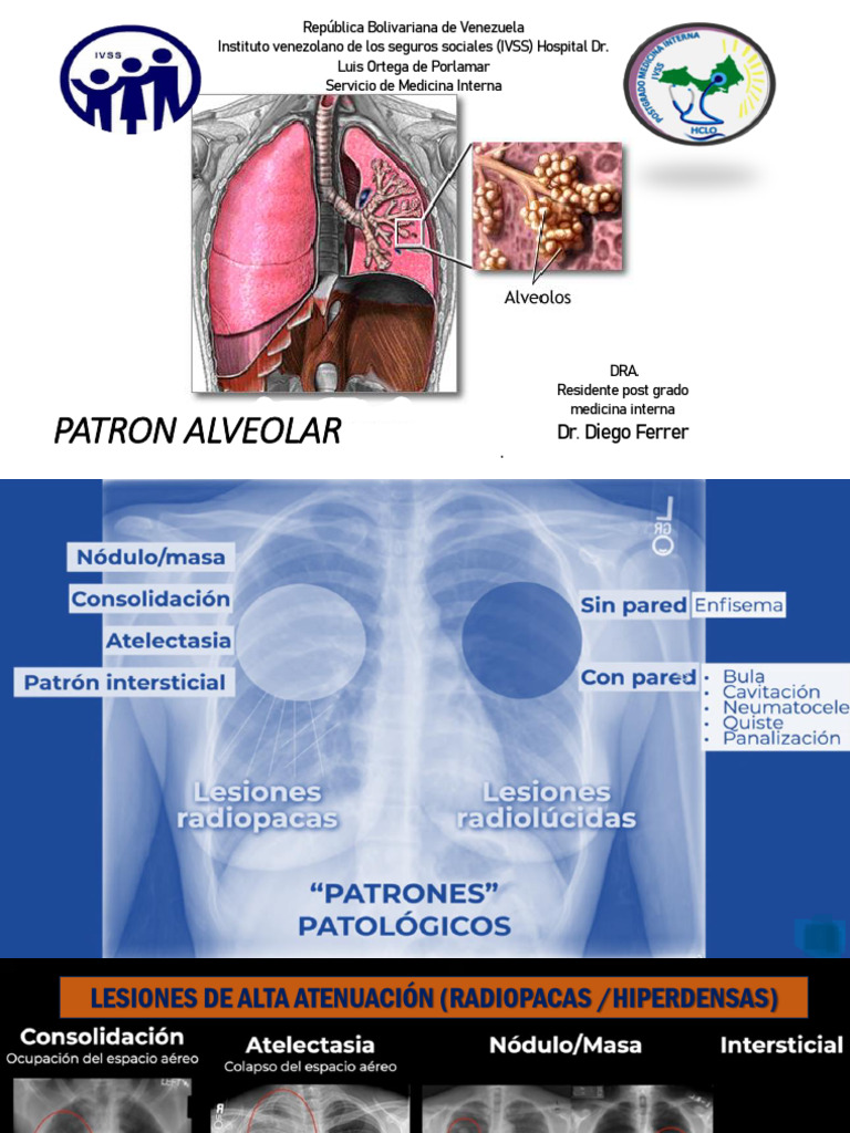 Patron Intersticial | PDF | Especialidades Medicas | Medicina CLINICA