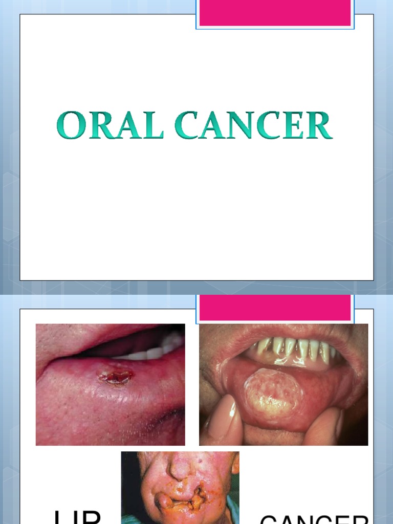 Oral Cancer | PDF