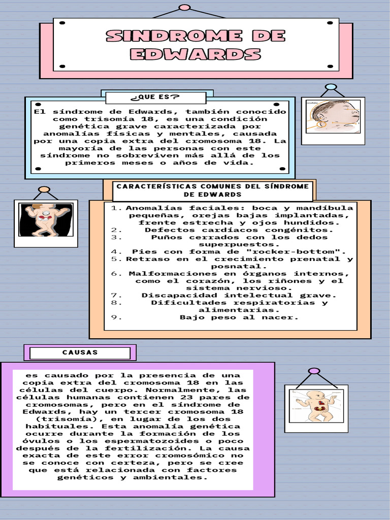 Sindrome de Edwards | PDF