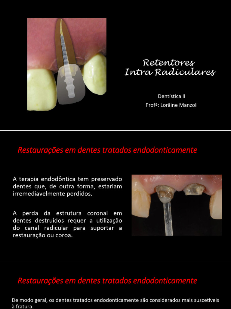 Pinos - Retentores Intra Radiculares | PDF | Dente humano | Boca