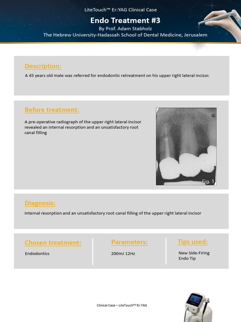Endo Treatment 3 With LiteTouch™ Er YAG Dental Laser | PDF | Science ...