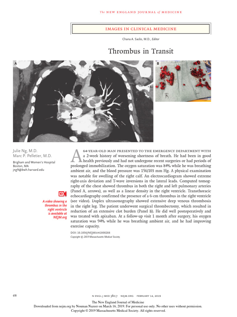 Thrombus in Transit PE | Download Free PDF | Thrombus | Breathing