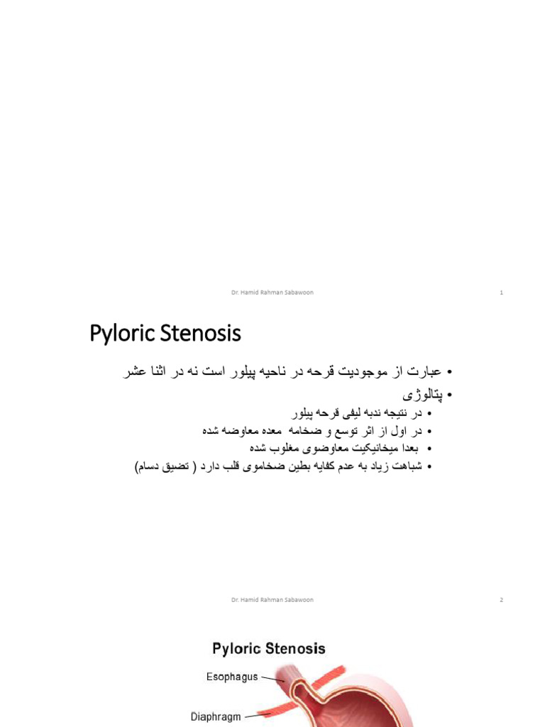 Pyloric Stenosis | PDF