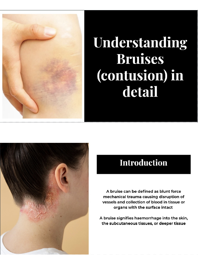 Bruise | PDF