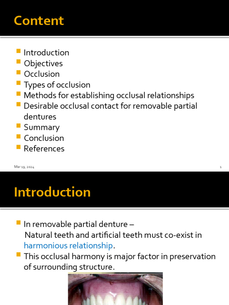 Occlusion in Rpd | PDF | Dentures | Mouth