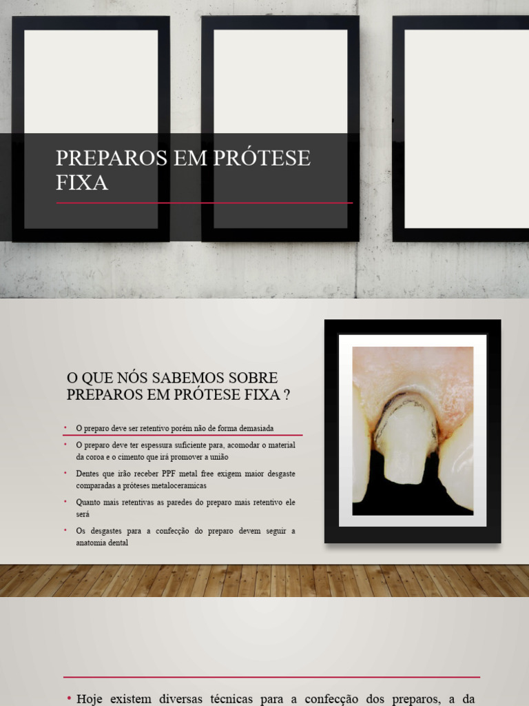 Aula4, Preparos em Protese Fixa | PDF | Dente humano | Boca