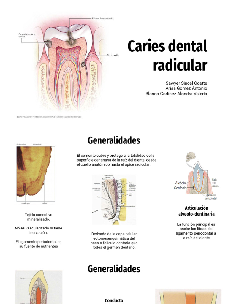 Caries Dental Radicular | PDF | Diente | Esmalte de dientes