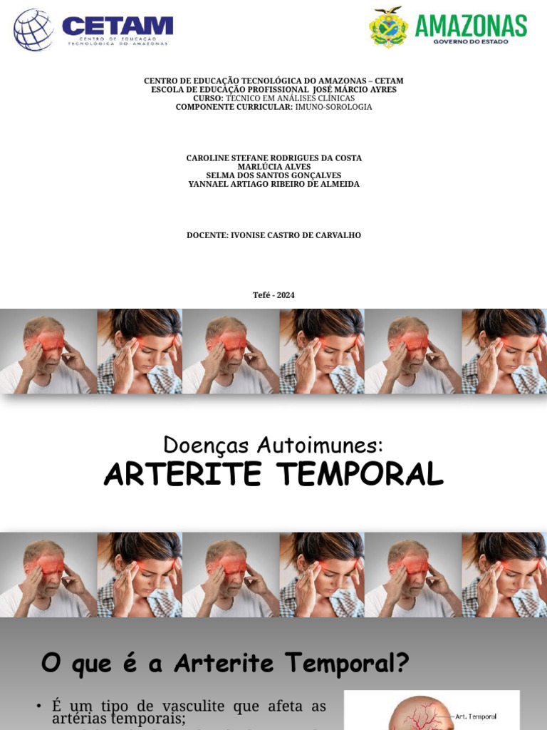 CETAM Arterite Temporal Novo | PDF | AVC | Causas de morte