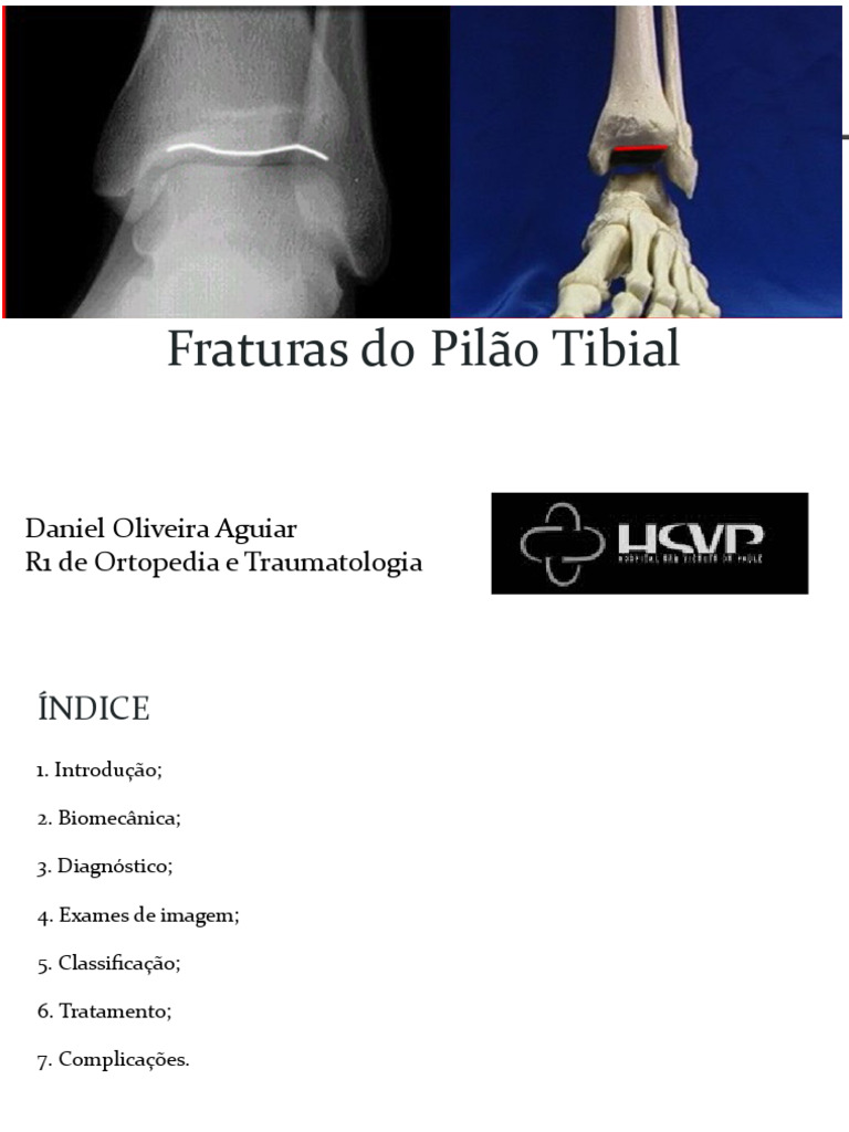 Fraturas Do Pilão Tibial | PDF | Fixação (Histologia) | Doenças e ...