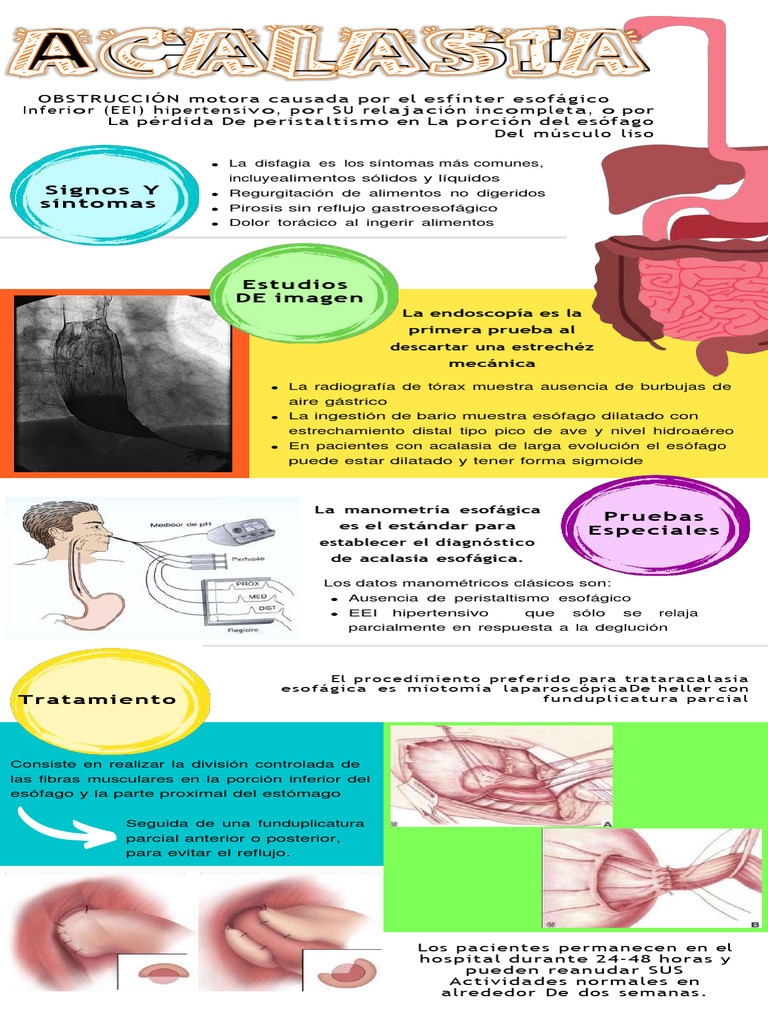 Infografia Acalasia | PDF