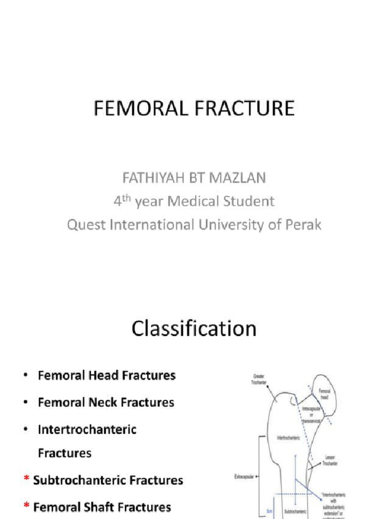 Femoral Fracture | PDF