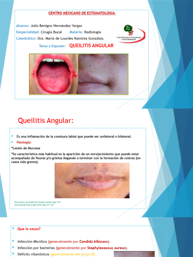 Exposición de Queilitis Angular - Julio Benigno Hernandez Vargas ...
