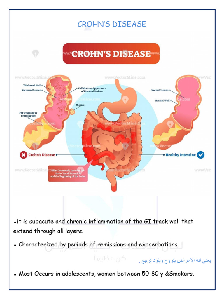 Crohns Disease | PDF