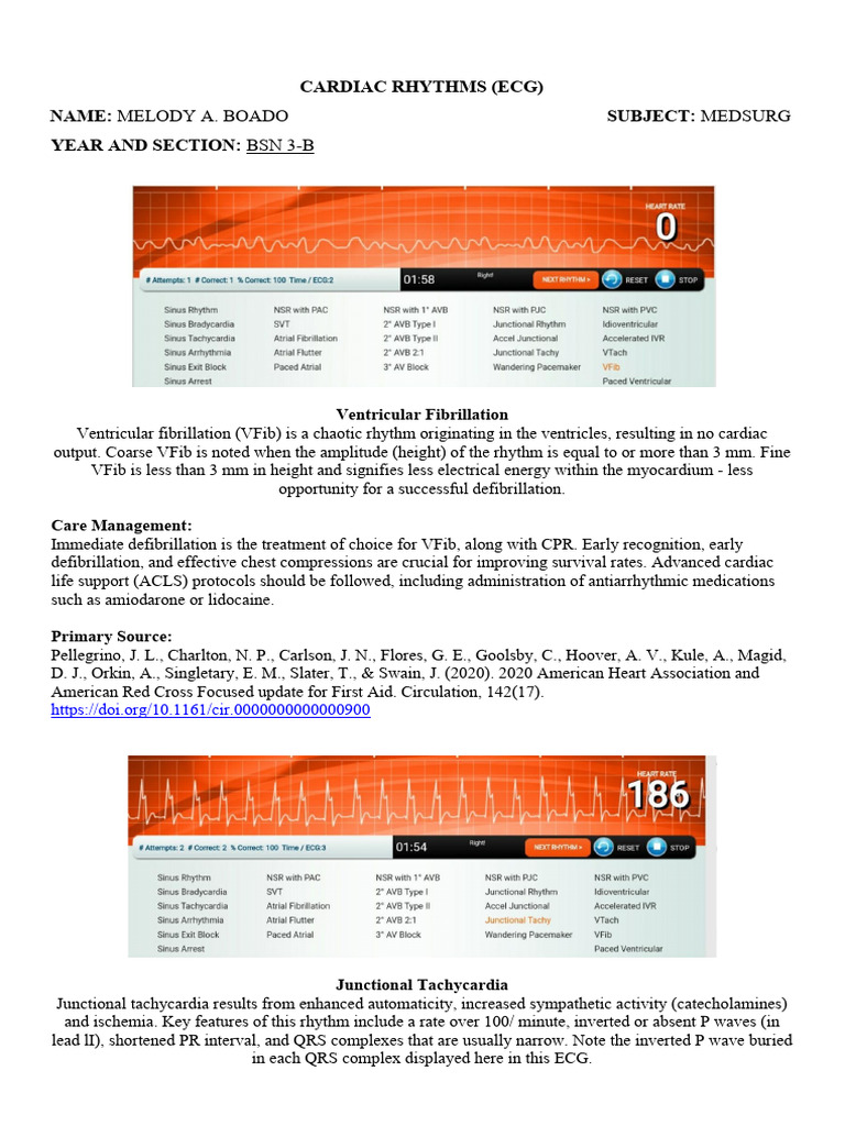 Cardiac Rhythms (Ecg) Name: Melody A. Boado Subject: Medsurg Year and Section: BSN | PDF ...