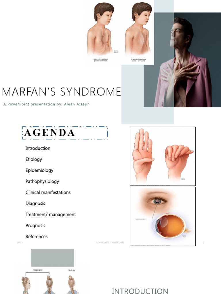 Marfan's Syndrome-Embryology & Histology | Download Free PDF | Medical ...
