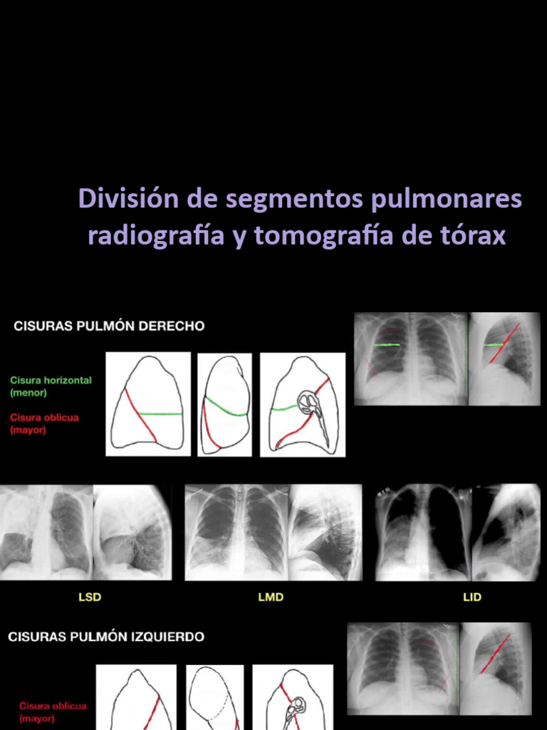 DIVISION LOBULOS | PDF | Tórax (anatomía humana)