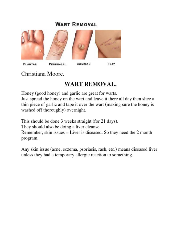 Wart Removal | PDF
