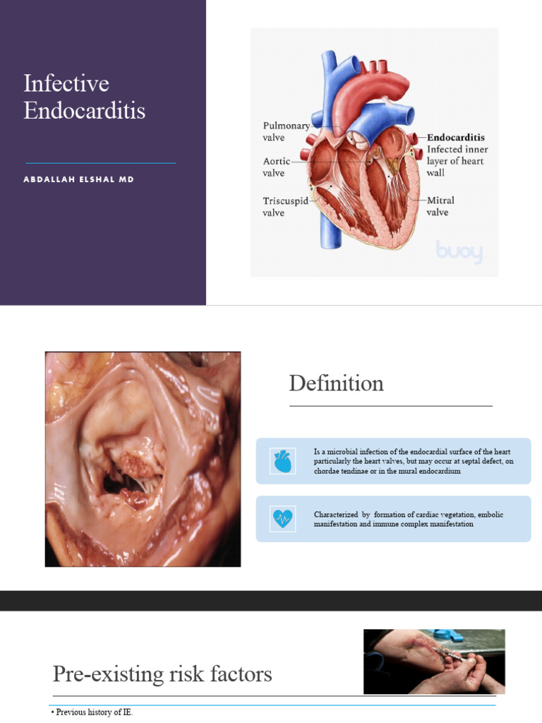 Infective Endocarditis Overview and Management | PDF | Heart ...
