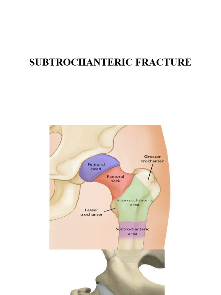 Subtrochanteric Fracture | PDF
