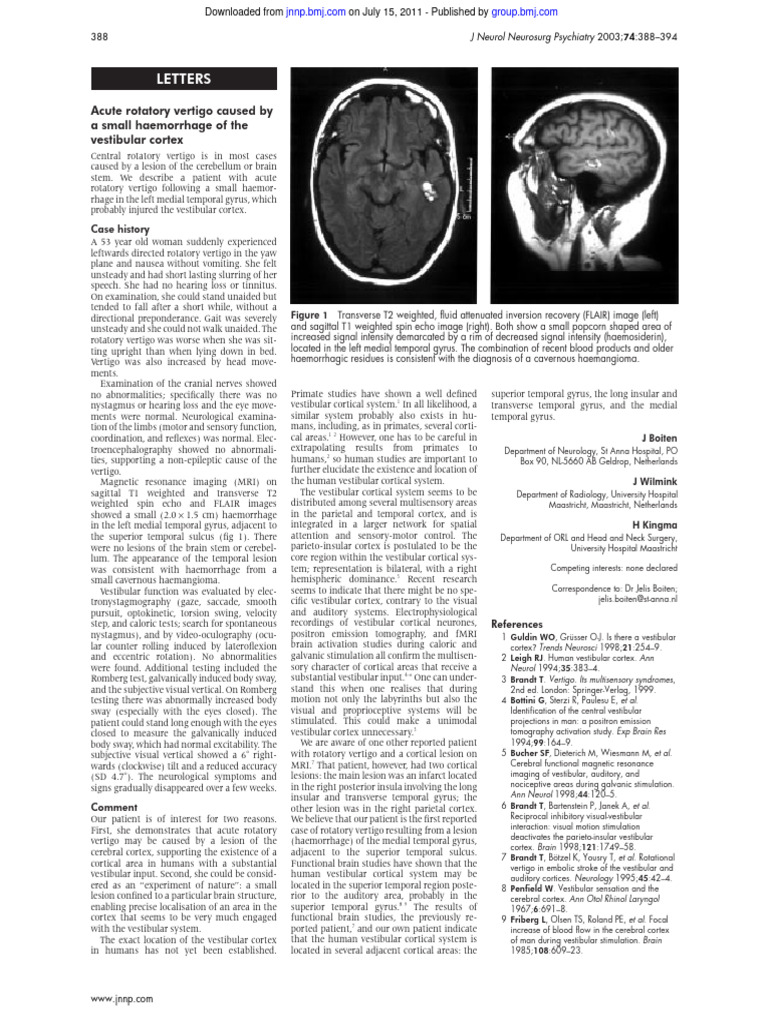 Acute Rotatory Vertigo Caused by A Small | PDF | Vertigo | Insular Cortex