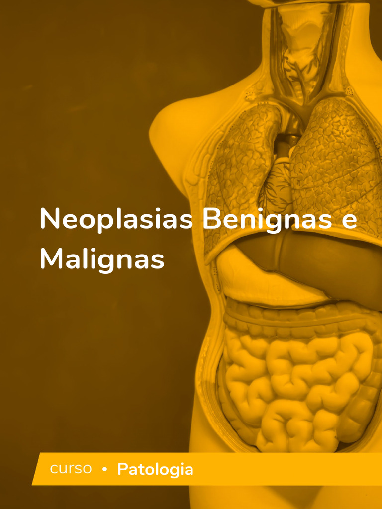 Neoplasias Benignas e Malignas | PDF | Neoplasmas | Câncer